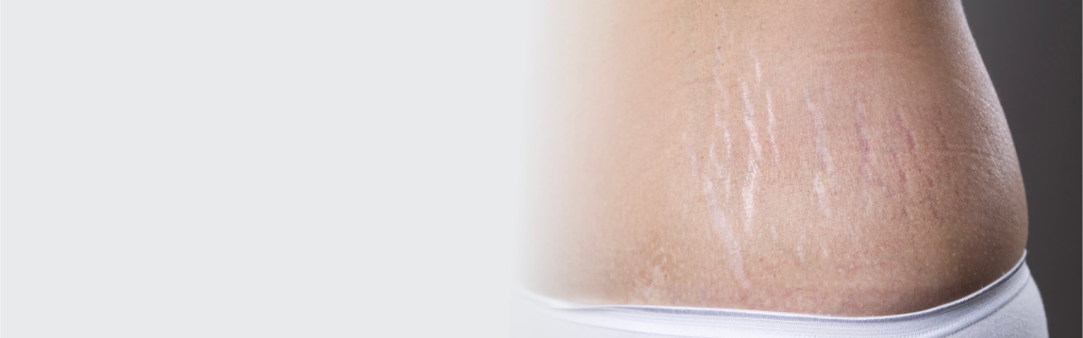 Expert Stretch Marks Removal Treatment in Goregaon, Mumbai